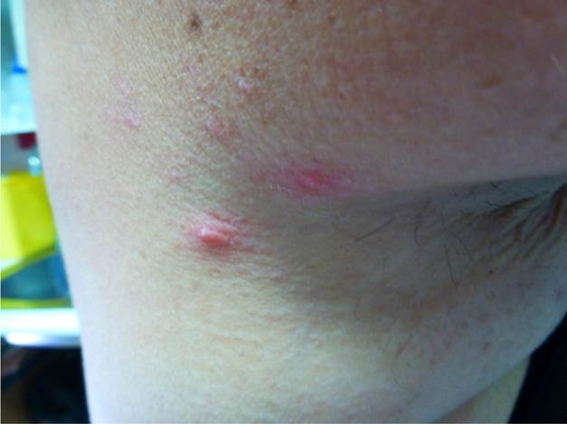 Foliculitis por Pseudomonas