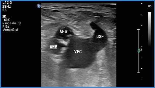 Vena Femoral Vena Safena