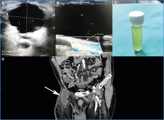 Persistent lymphocele after treatment of acute ischemia in a patient ...
