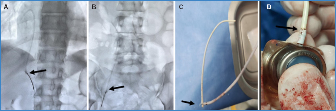 Manejo endovascular de migración de catéter de quimioterapia: una ...
