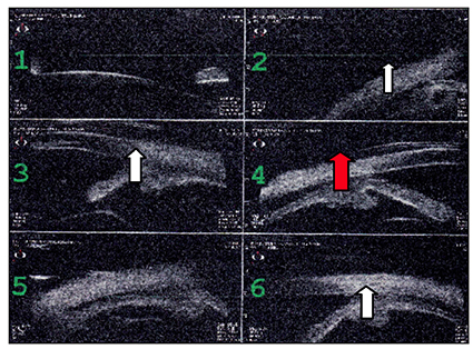 Traumatic cyclodialysis treated with cryopexy