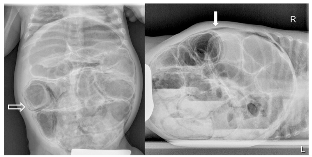 Signos Radiologicos Del Neumoperitoneo