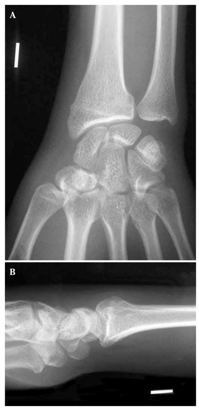 Distal radial torus fracture in an adult. A new type of occult wrist ...