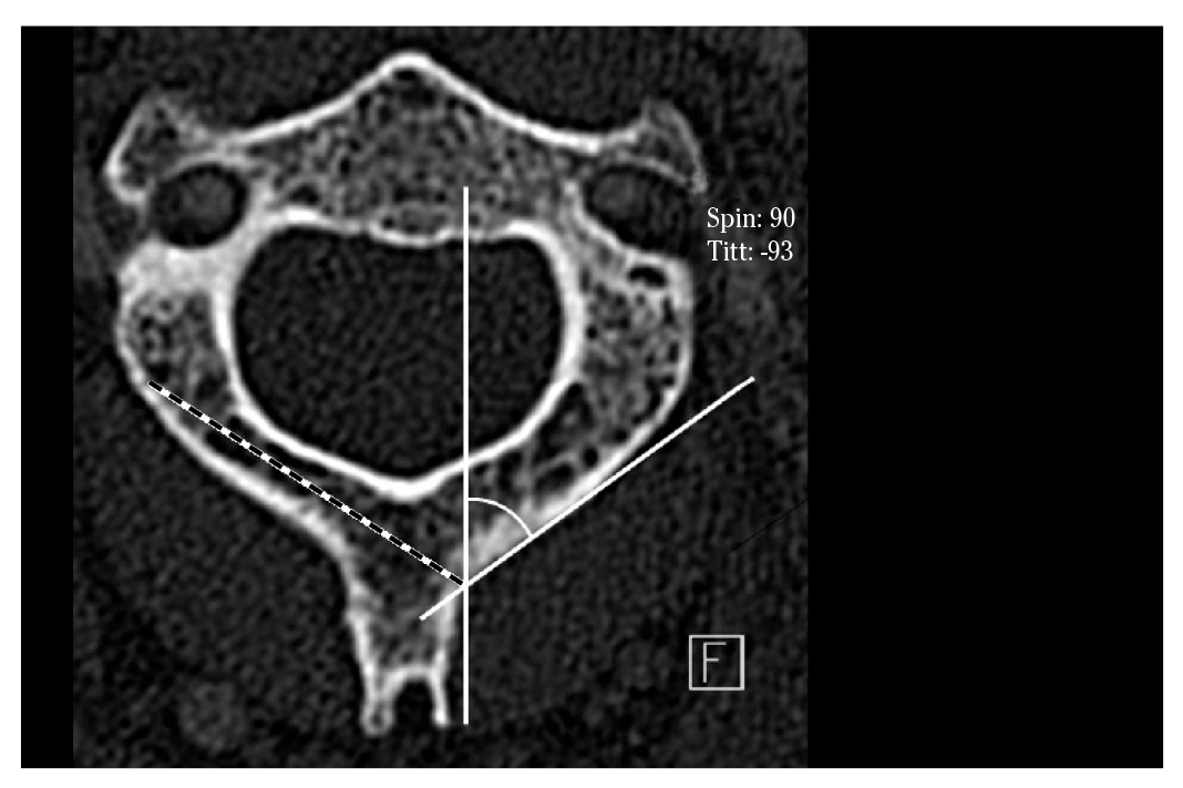 The dimensions of the posterior arch of C2 for instrumented screw ...