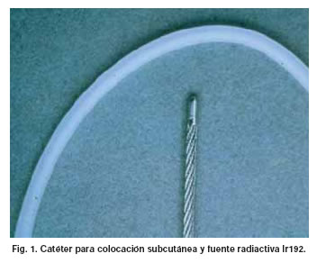 Tratamiento Combinado De Los Queloides Mediante Cirug a Y Braquiterapia