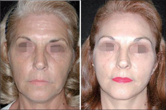 Miectomía frontal: una alternativa para reducir arrugas frontales