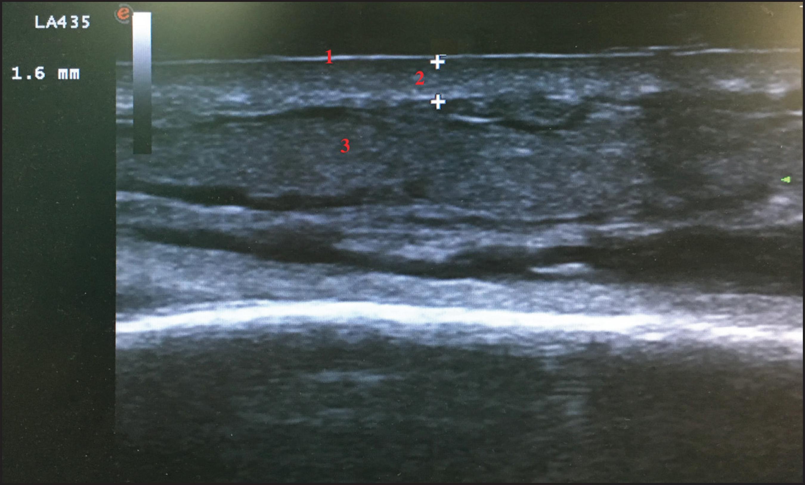 Ultrasonografía cutánea: una herramienta objetiva para la toma de ...