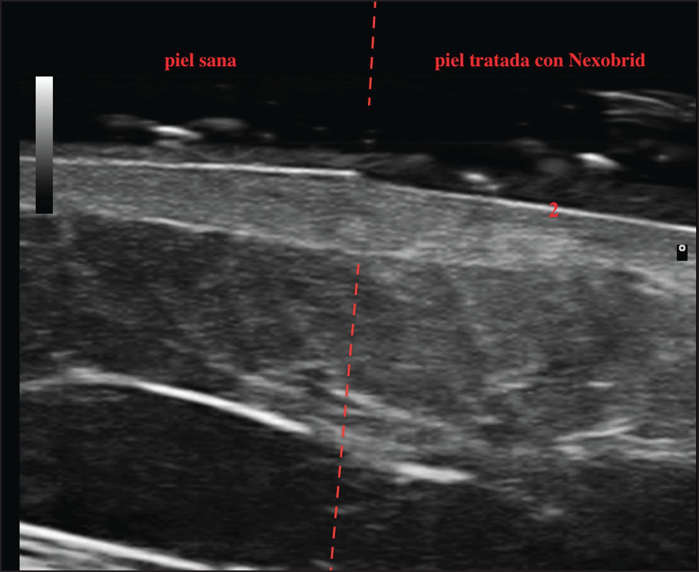 Ultrasonografía cutánea: una herramienta objetiva para la toma de ...