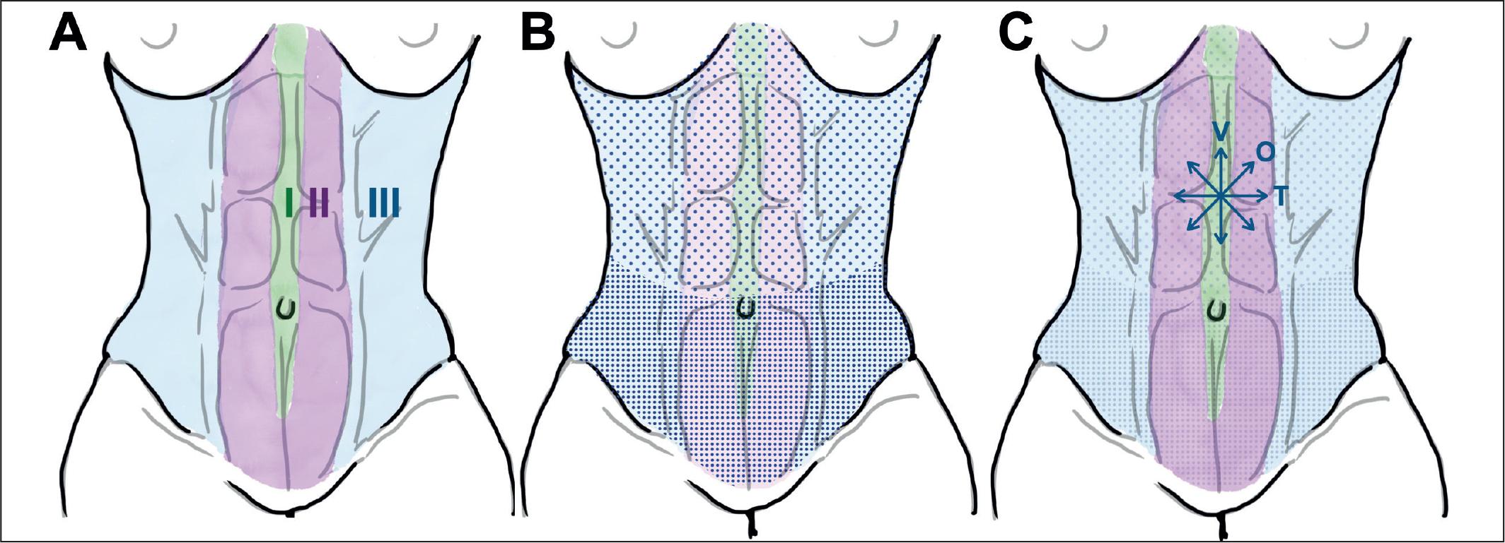 Presentación de una nueva clasificación de plicaturas en abdominoplastia