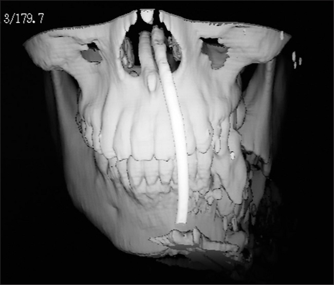 Reconstruction of complex mandibular defect using scapular flap with ...