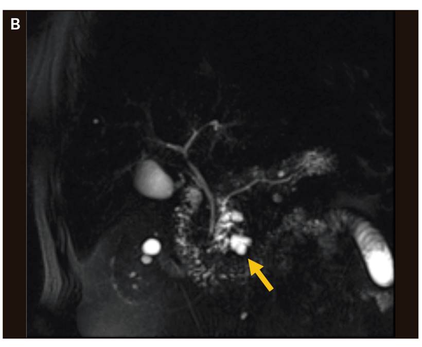 Intraductal papillary mucinous neoplasm (IPMN) of the pancreas ...