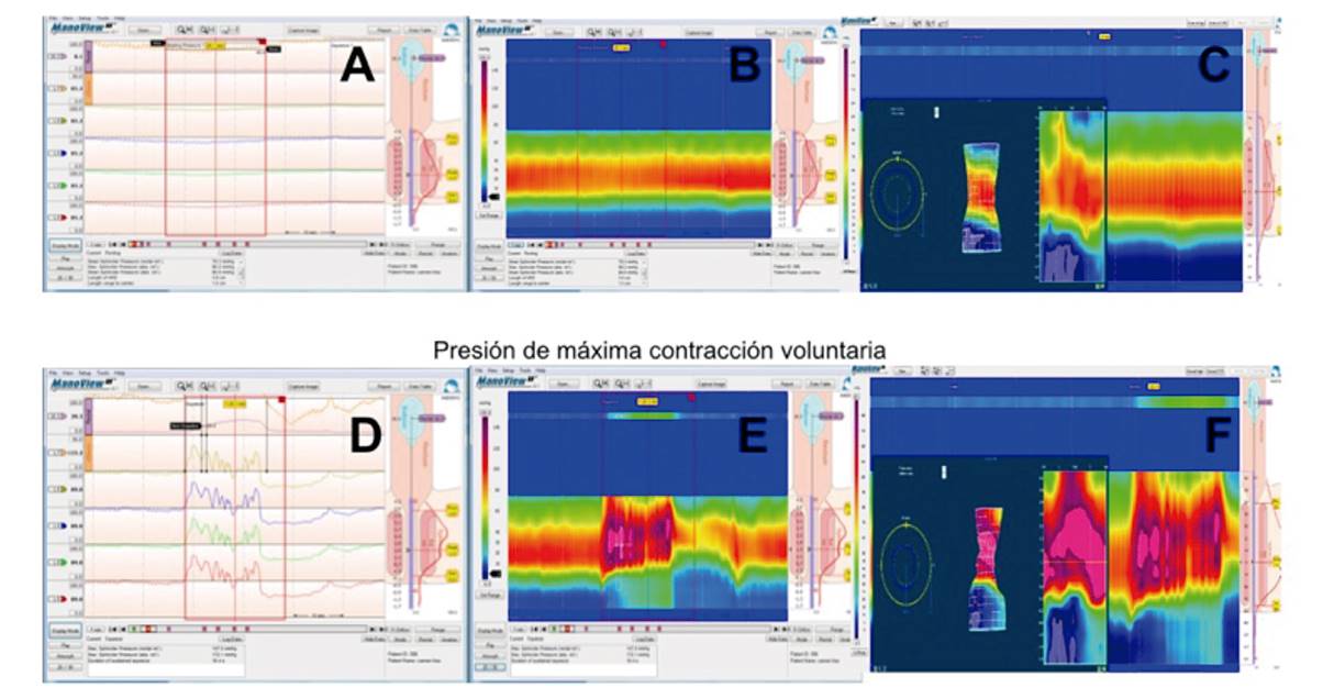 Manometría anorrectal de alta resolución y de alta definición ...