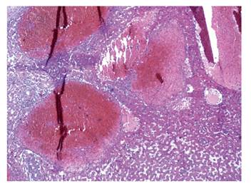 Spontaneous hepatic rupture in a bodybuilder: a case report and review ...