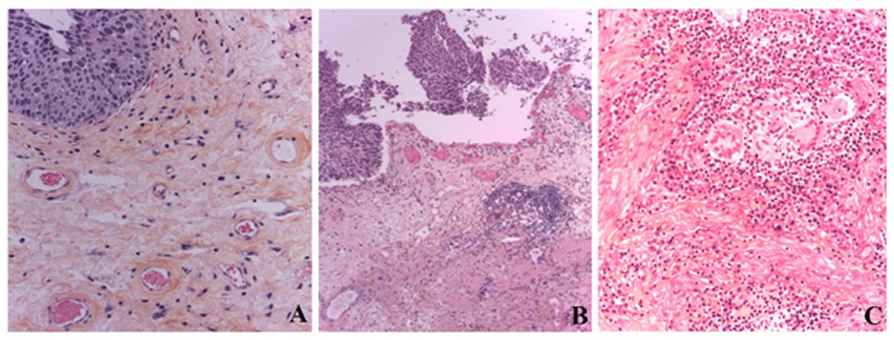 A review on the evolution of immunotherapy in bladder carcinoma