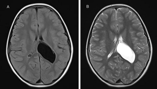 Coexistence of central precocious puberty and intraventricular ...