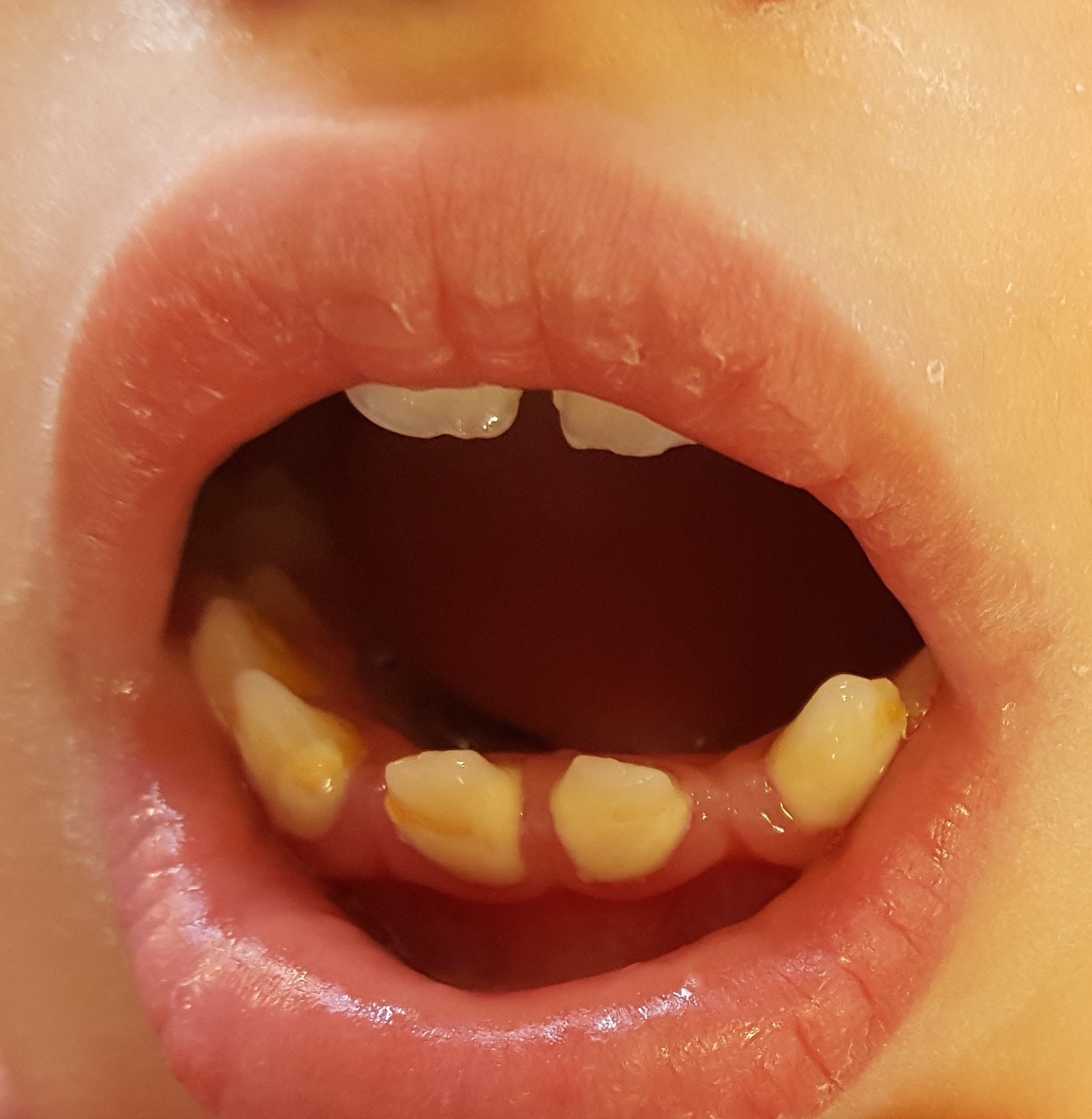 Rubinstein-Taybi syndrome: principal oral and dental disorders and ...