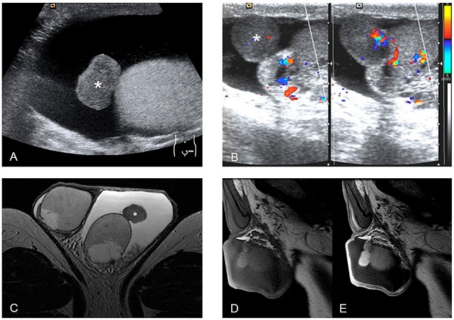 Fibroma testicular de origen gonadal estromal en un varón adulto