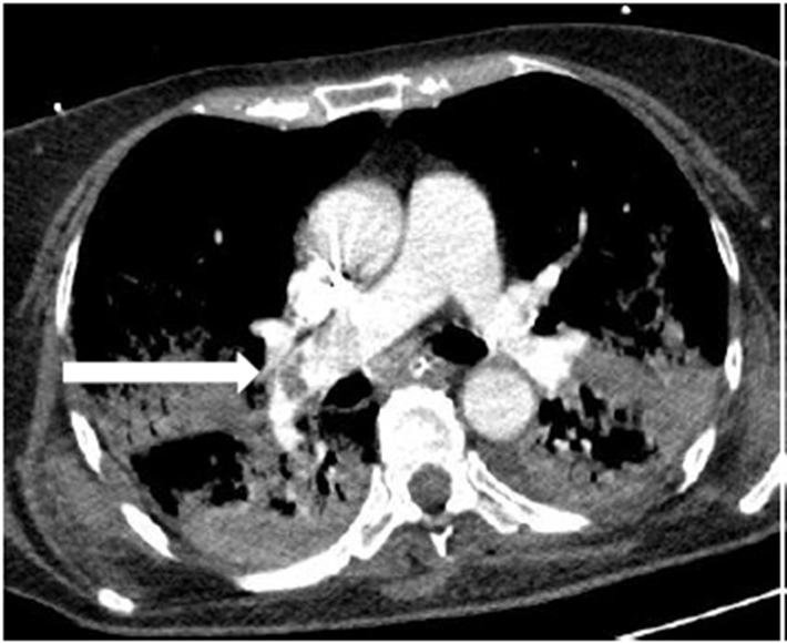 Tromboembolismo Pulmonar en los pacientes con COVID-19. Angiografía con ...