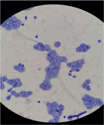 Meningeal carcinomatosis as the initial manifestation of lymphoma