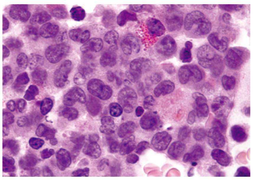 Sarcoma Mieloide Intraoral Forma Poco Com n De Debut De La Leucemia