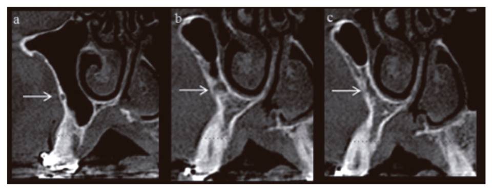 Modelo De Ducto Alveolar