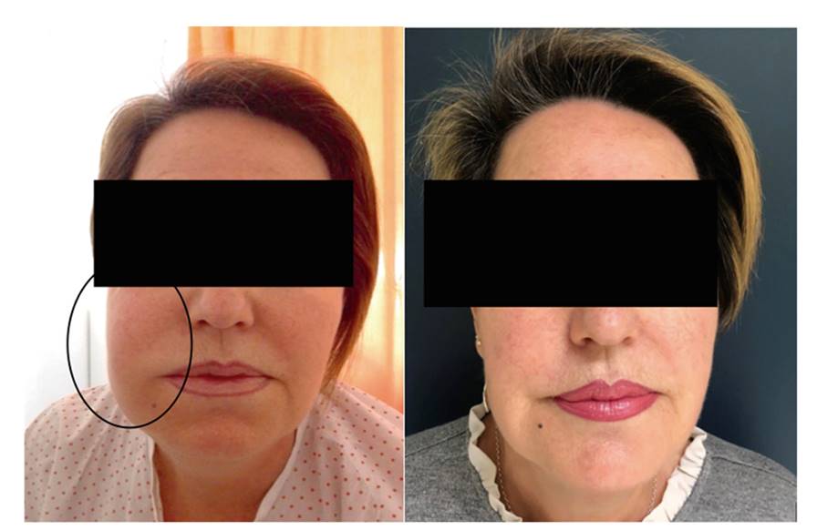 Edema facial por silicona tratado con minociclina: presentación de un caso