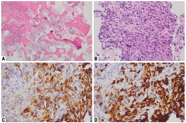 Histiocitose De Celulas De Langerhans Mandibula