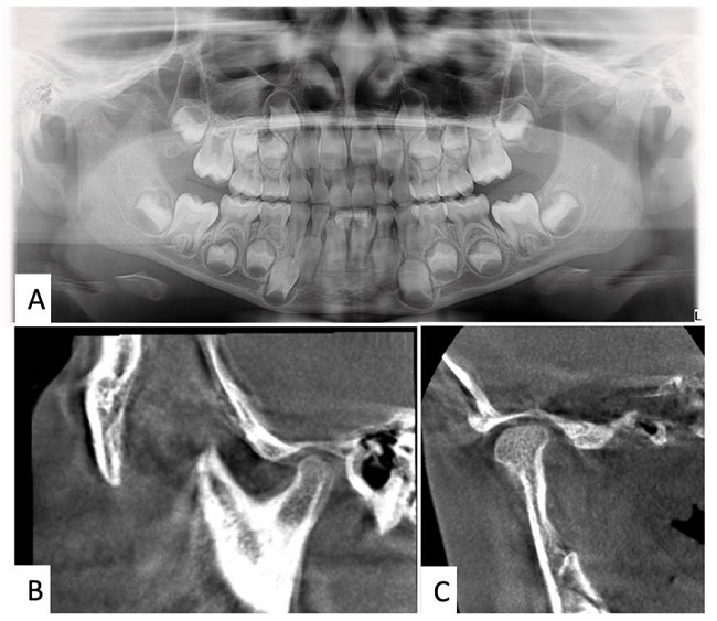 Histiocitose De Celulas De Langerhans Mandibula Langerhans Cell