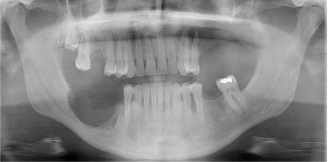 Histiocitosis de células de Langerhans con afectación maxilomandibular ...