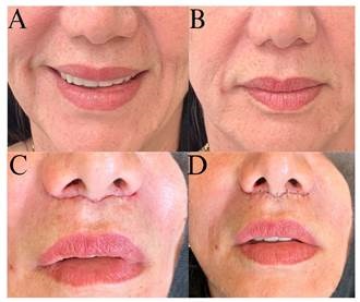 Aplicabilidad y limitaciones del levantamiento de labios para el ...