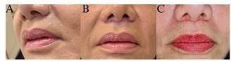 Aplicabilidad y limitaciones del levantamiento de labios para el ...