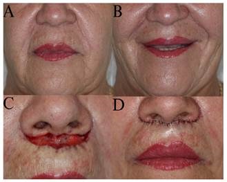 Aplicabilidad y limitaciones del levantamiento de labios para el ...