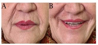 Aplicabilidad y limitaciones del levantamiento de labios para el ...