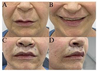Aplicabilidad y limitaciones del levantamiento de labios para el ...