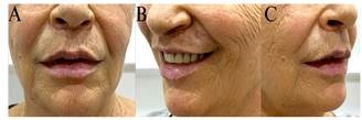 Aplicabilidad y limitaciones del levantamiento de labios para el ...