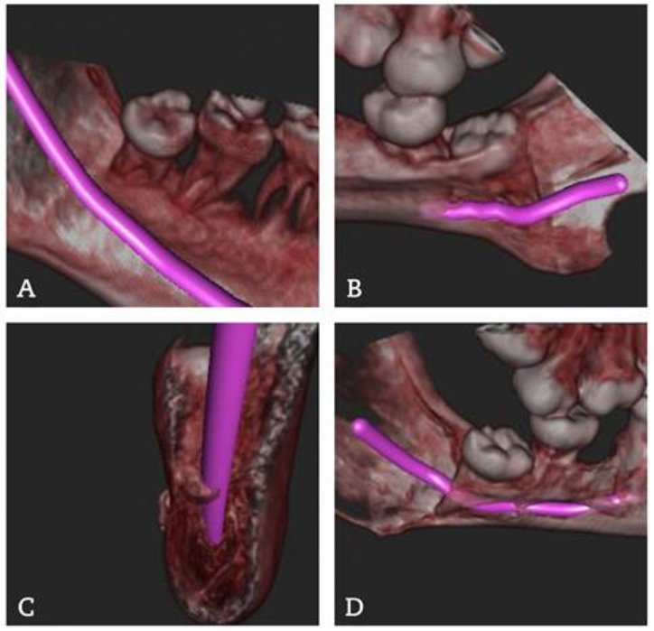Spatial relationship between mandibular third molar and the mandibular ...