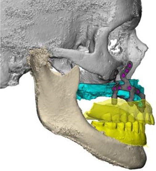 Orthognathic surgery and simultaneous implant-supported rehabilitation ...