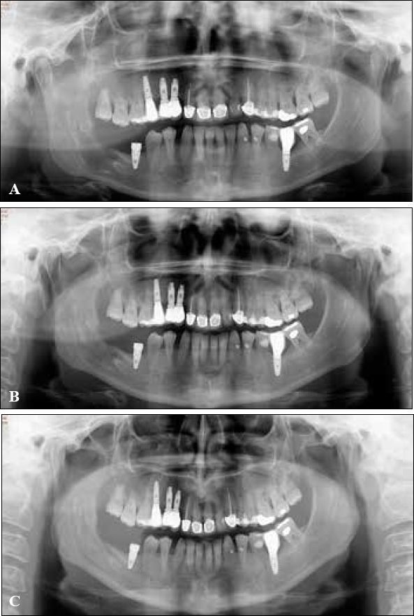 Clasificación De Fractura De Mandíbula
