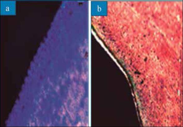 Tratamiento Laser-Lok® en implantes dentales. A propósito de un caso ...