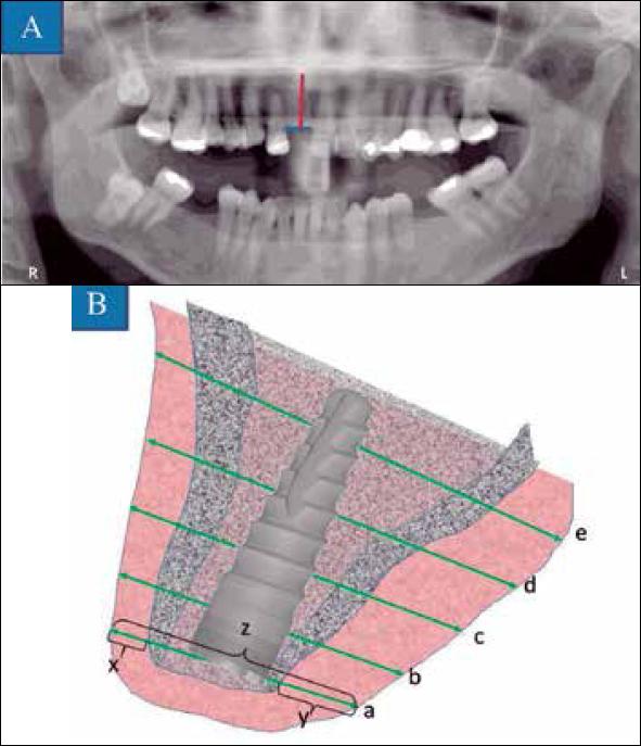 Tratamiento Laser-Lok® en implantes dentales. A propósito de un caso ...