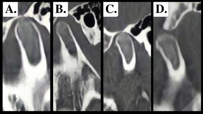 Desplazamiento discal de la articulación temporomandibular con y sin ...