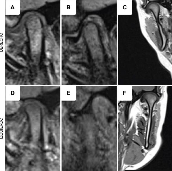 Desplazamiento discal de la articulación temporomandibular con y sin ...