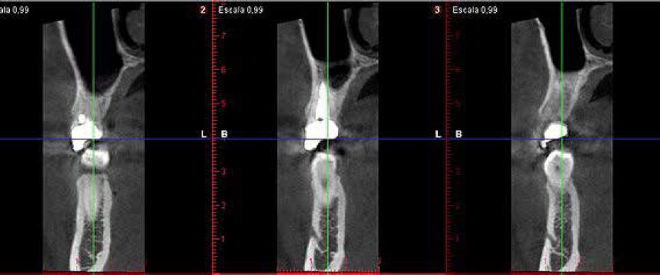 Radiografia De Osteite Alveolar