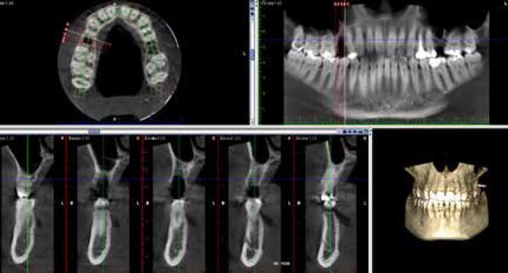 Radiografia De Osteite Alveolar