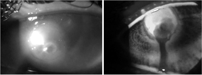 Manejo del tratamiento de úlcera corneal perforada secundaria a una ...