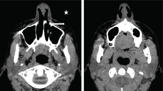 Carcinoma epidermoide del septum nasal secundario al consumo de cocaína ...