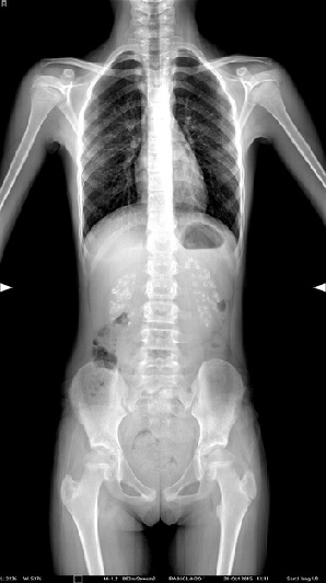 Nefrocalcinosis, un hallazgo casual, pero un signo guía