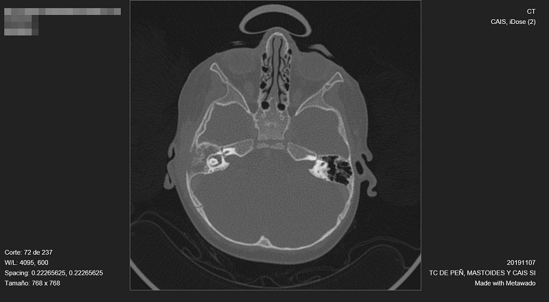 Otomastoiditis aguda en edad pediátrica, una forma excepcional de ...