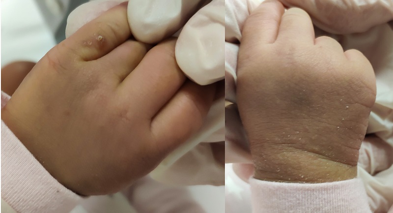 Infant scabies: dermoscopic diagnosis and Müller test