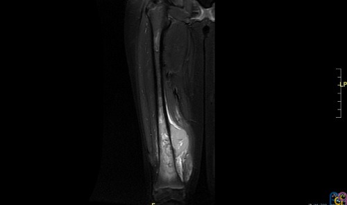 Sarcoma Osteogenico Triangulo De Codman Tumores óseos.